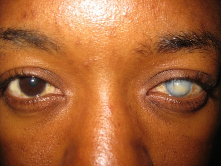 Reversible Blindness – Ghaswala Vision Foundation